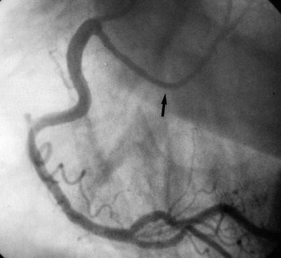 Coronary Angiography | Thoracic Key