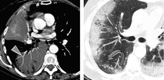 Diseases | Thoracic Key
