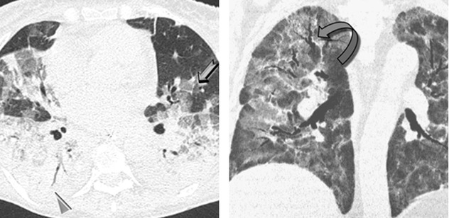 Diseases | Thoracic Key