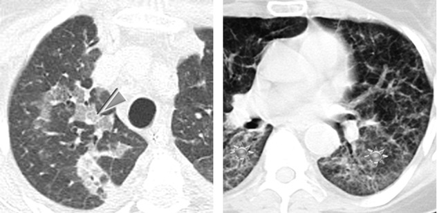 Diseases | Thoracic Key
