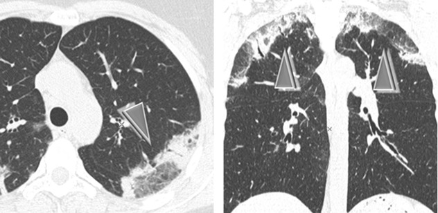 Diseases | Thoracic Key