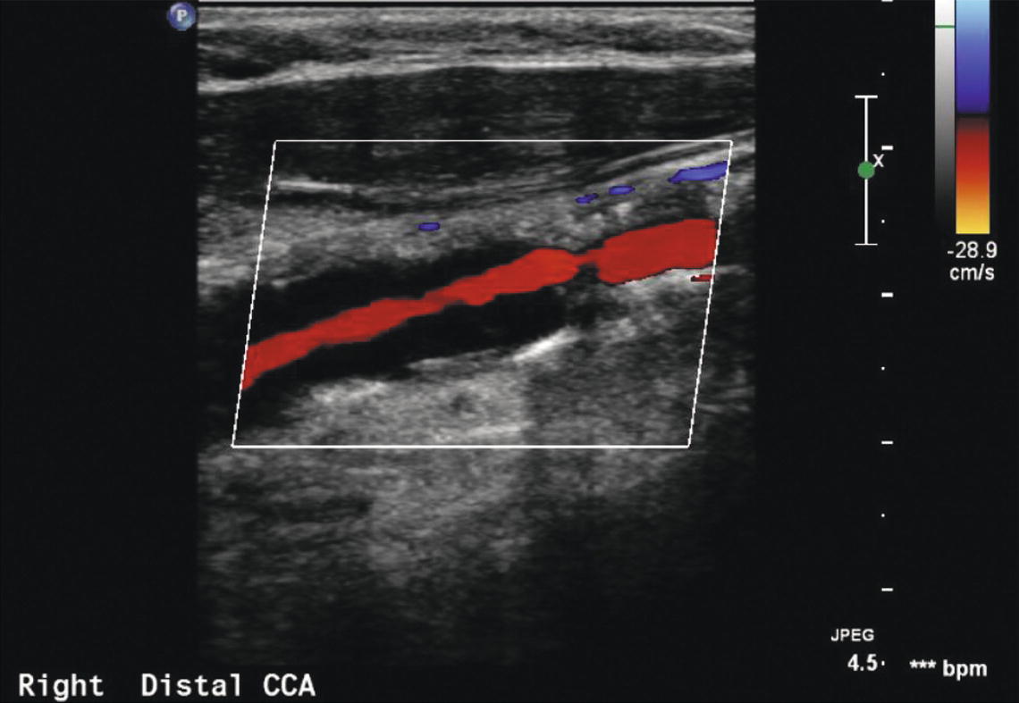Extracranial Carotid and Vertebral Arteries | Thoracic Key