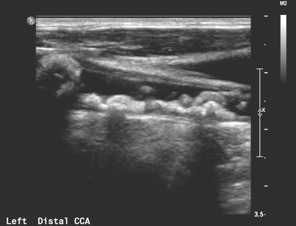 Extracranial Carotid and Vertebral Arteries | Thoracic Key