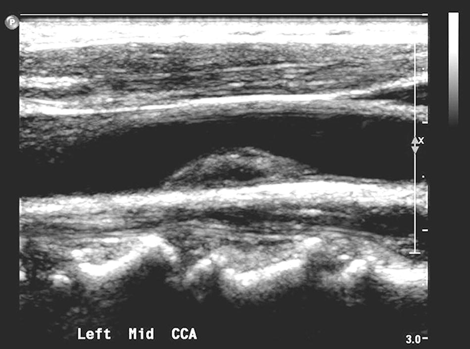 Extracranial Carotid and Vertebral Arteries | Thoracic Key