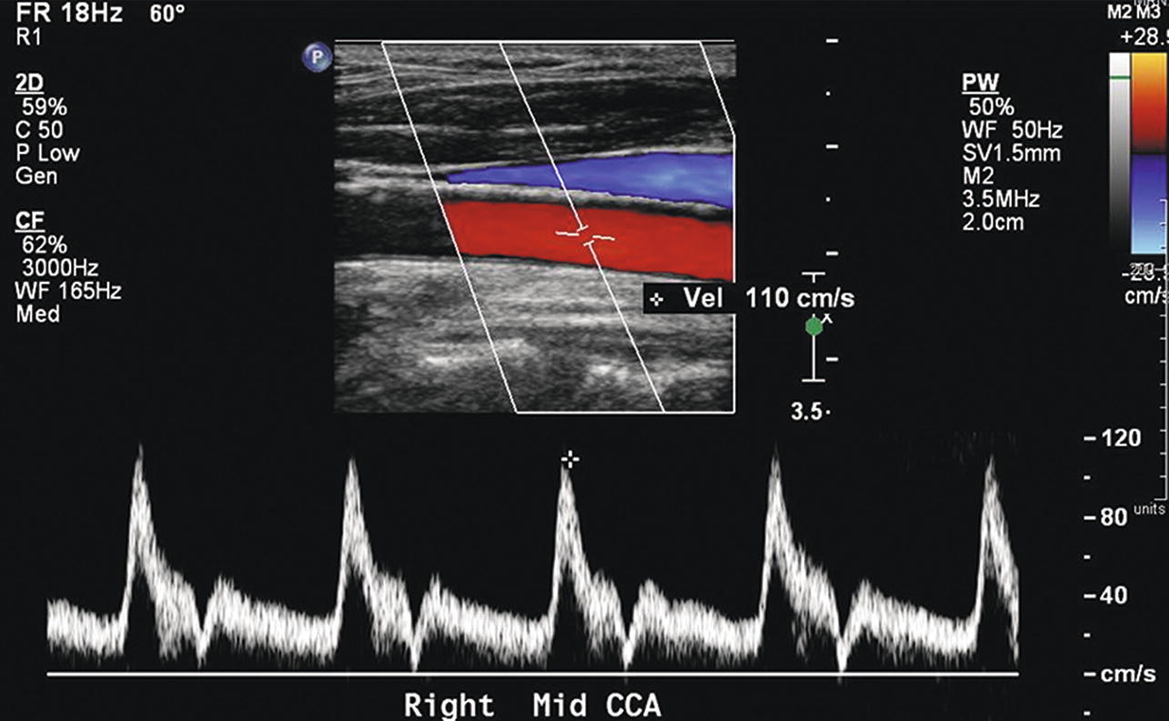 Extracranial Carotid and Vertebral Arteries | Thoracic Key