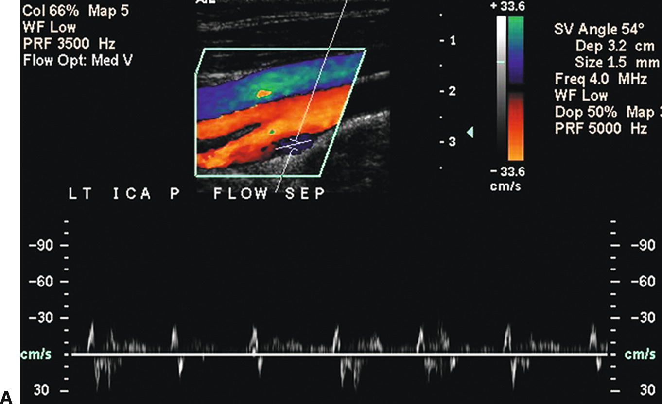 Extracranial Carotid and Vertebral Arteries | Thoracic Key