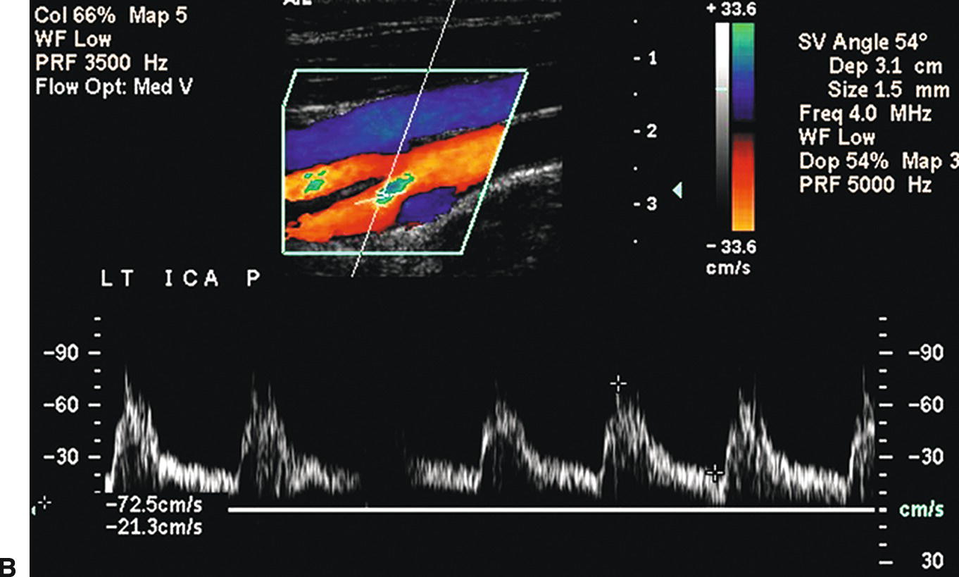Extracranial Carotid and Vertebral Arteries | Thoracic Key