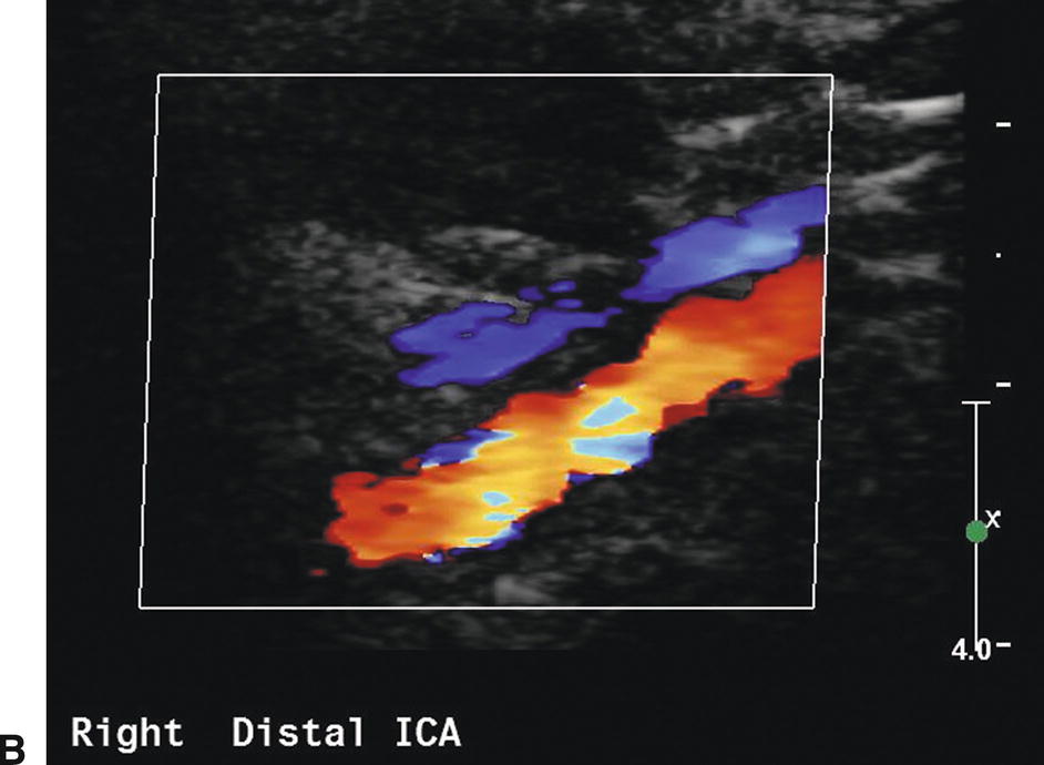 Extracranial Carotid and Vertebral Arteries | Thoracic Key
