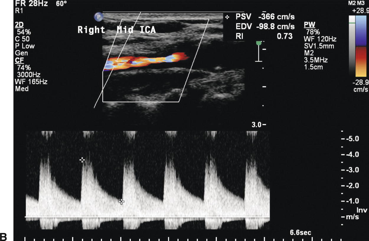Extracranial Carotid and Vertebral Arteries | Thoracic Key