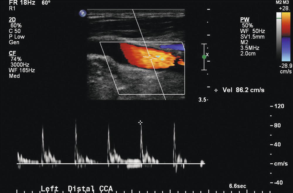 Extracranial Carotid and Vertebral Arteries | Thoracic Key