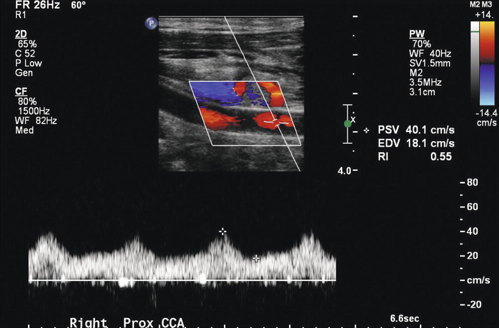 Extracranial Carotid and Vertebral Arteries | Thoracic Key
