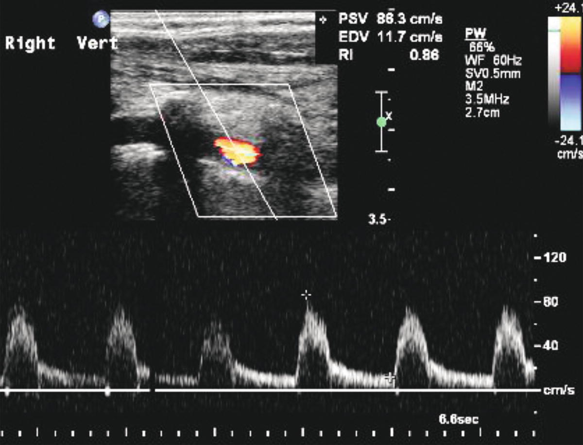 Extracranial Carotid and Vertebral Arteries | Thoracic Key