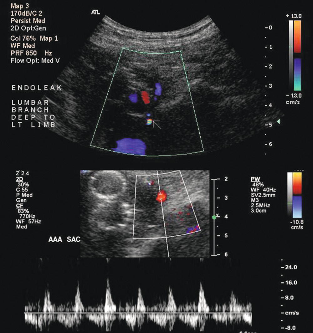 Duplex Assessment of Aortic Endografts | Thoracic Key