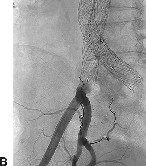 Duplex Assessment of Aortic Endografts | Thoracic Key