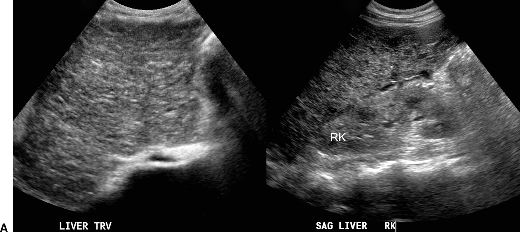 Ultrasound Evaluation of the Portal and Hepatic Veins | Thoracic Key