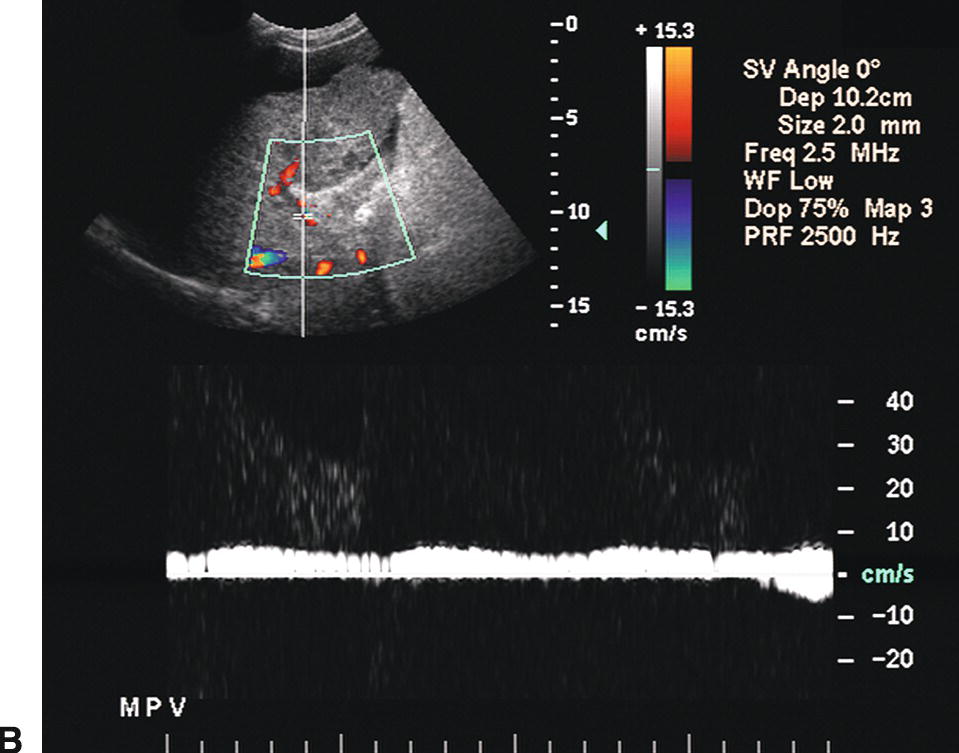 Ultrasound Evaluation of the Portal and Hepatic Veins | Thoracic Key