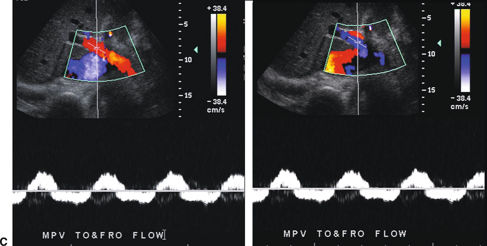 Ultrasound Evaluation of the Portal and Hepatic Veins | Thoracic Key