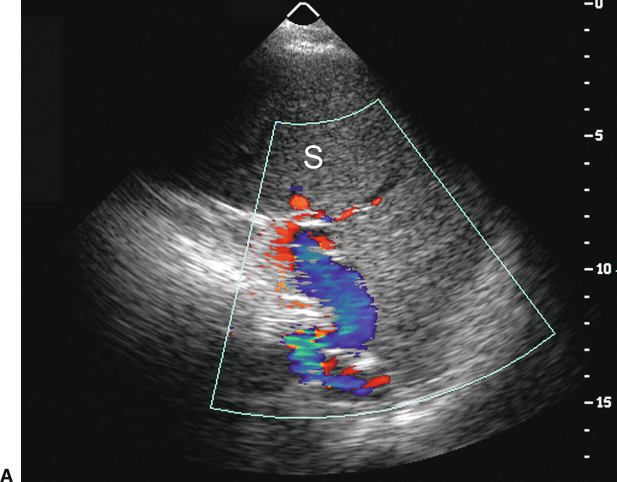 Ultrasound Evaluation of the Portal and Hepatic Veins | Thoracic Key