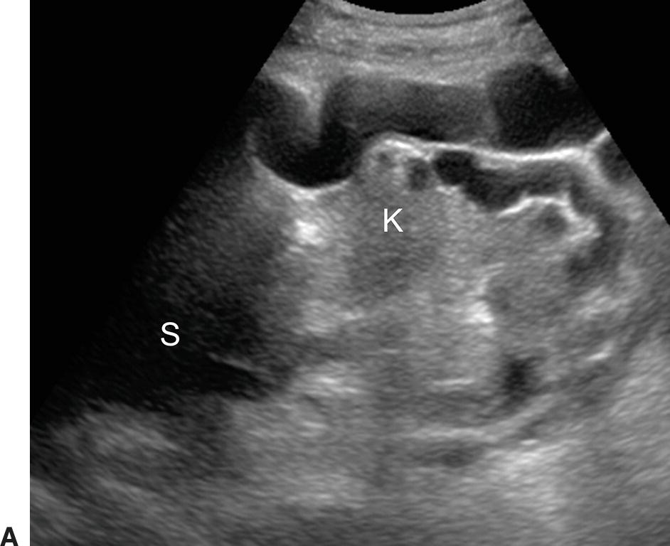 Ultrasound Evaluation of the Portal and Hepatic Veins | Thoracic Key