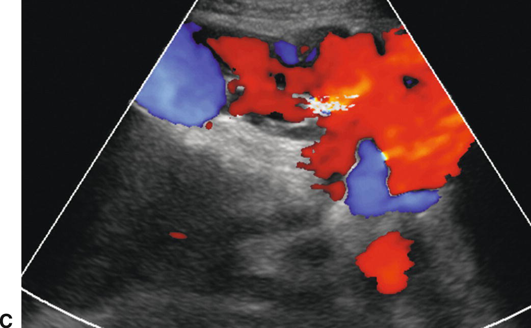 Ultrasound Evaluation of the Portal and Hepatic Veins | Thoracic Key