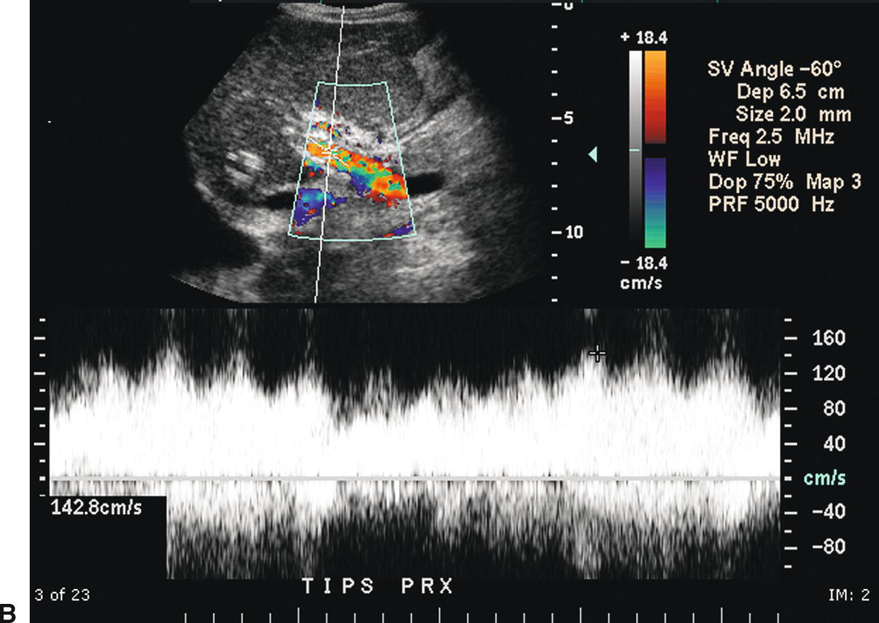 Ultrasound Evaluation of the Portal and Hepatic Veins | Thoracic Key