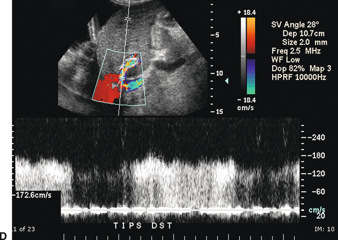 Ultrasound Evaluation of the Portal and Hepatic Veins | Thoracic Key