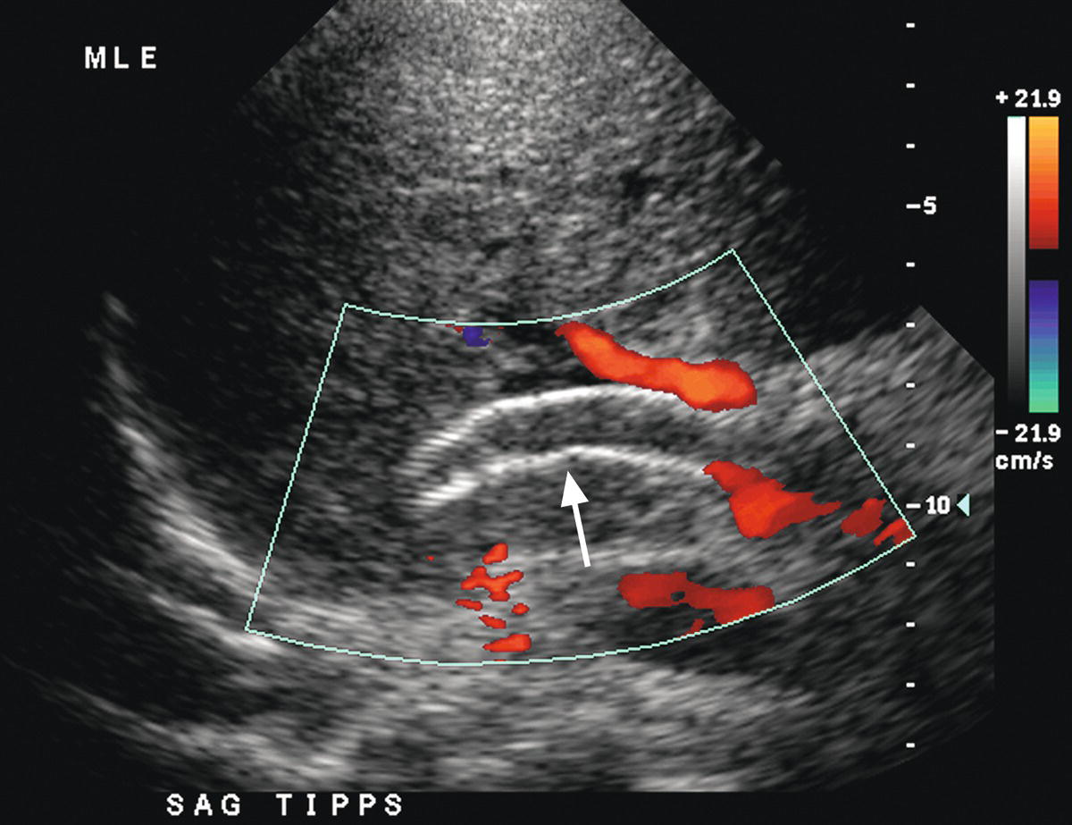 Ultrasound Evaluation of the Portal and Hepatic Veins | Thoracic Key