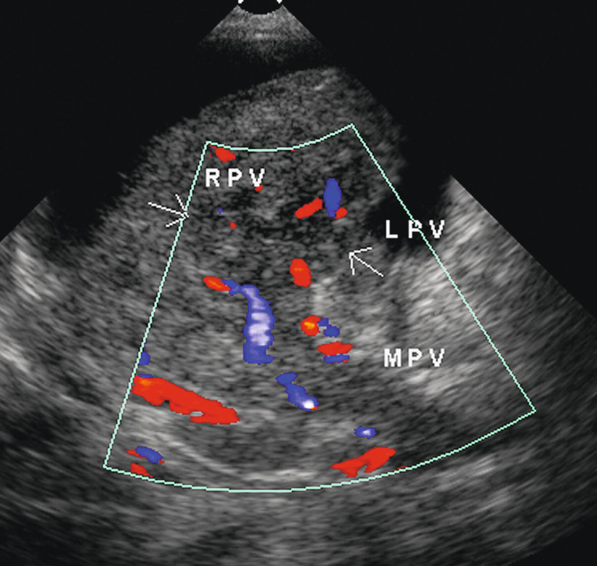 Ultrasound Evaluation of the Portal and Hepatic Veins | Thoracic Key