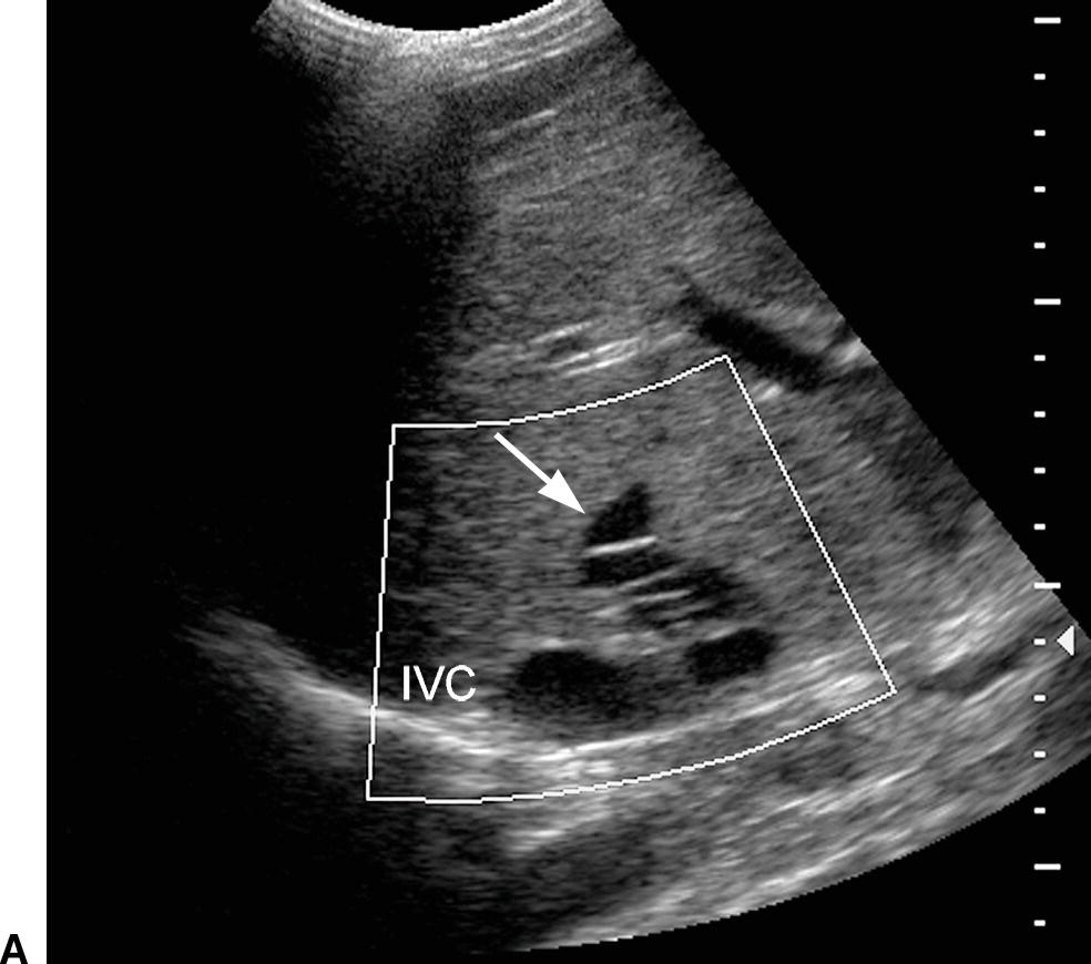 Ultrasound Evaluation of the Portal and Hepatic Veins | Thoracic Key