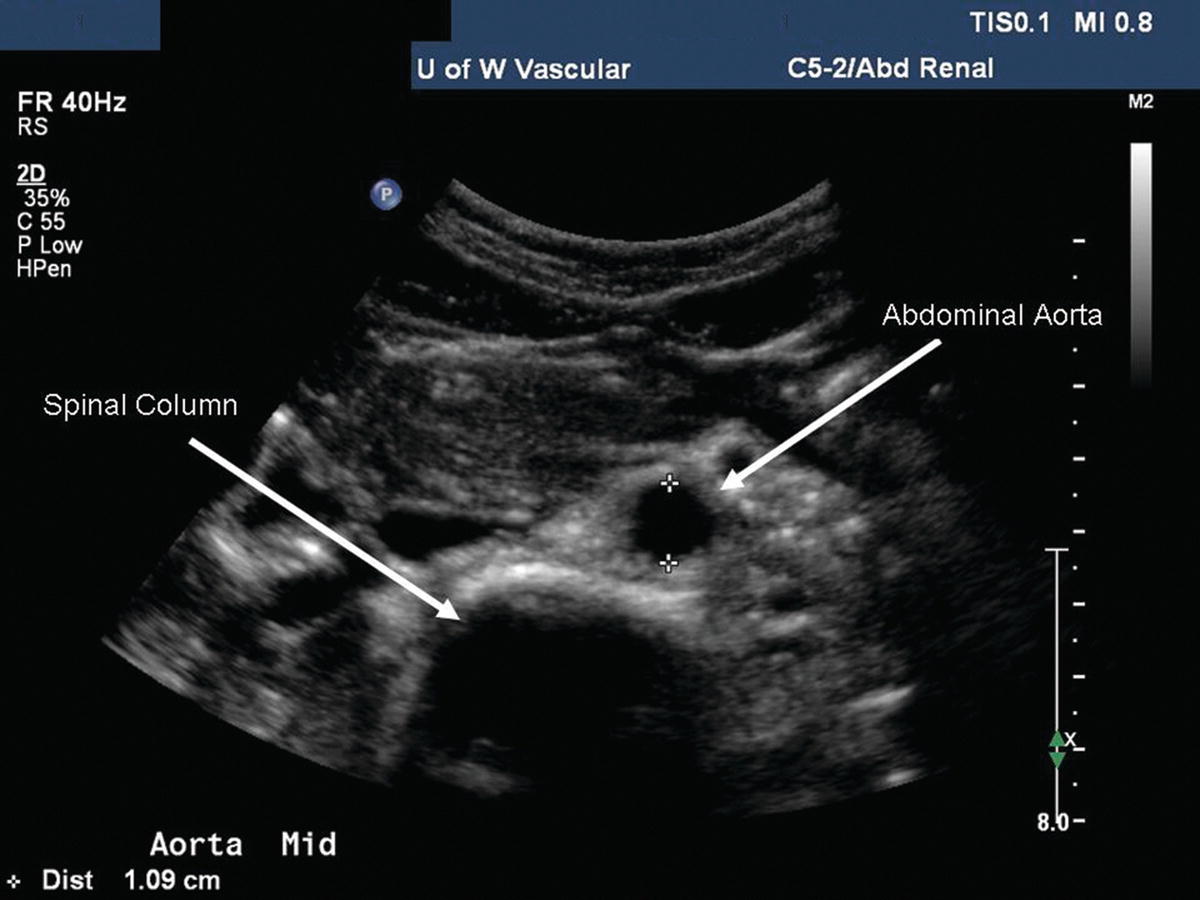 Renal Duplex Scanning | Thoracic Key