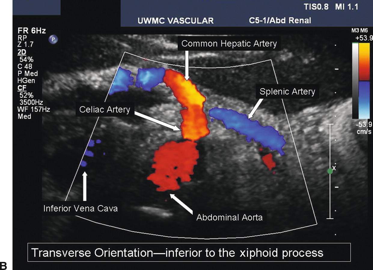 Renal Duplex Scanning | Thoracic Key