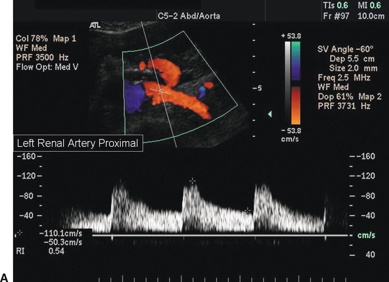 Renal Duplex Scanning | Thoracic Key