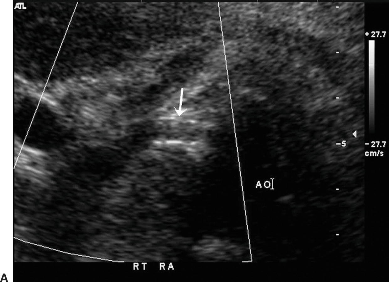 Renal Duplex Scanning | Thoracic Key