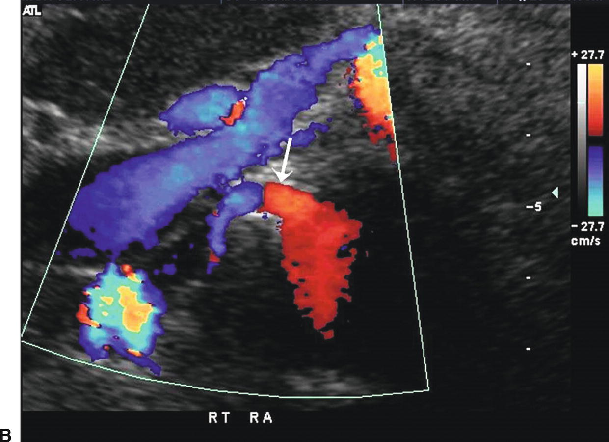 Renal Duplex Scanning | Thoracic Key