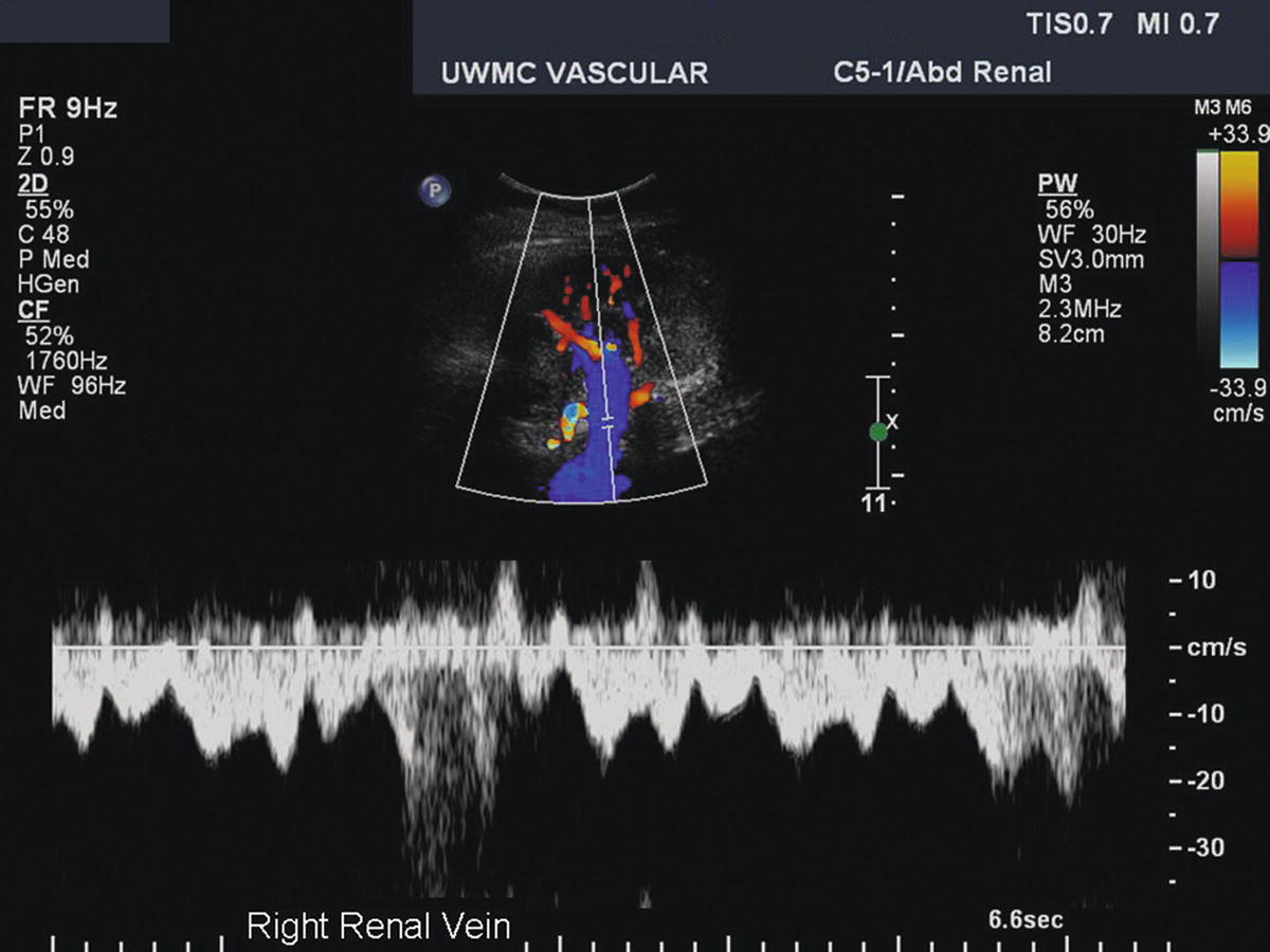 Renal Duplex Scanning | Thoracic Key