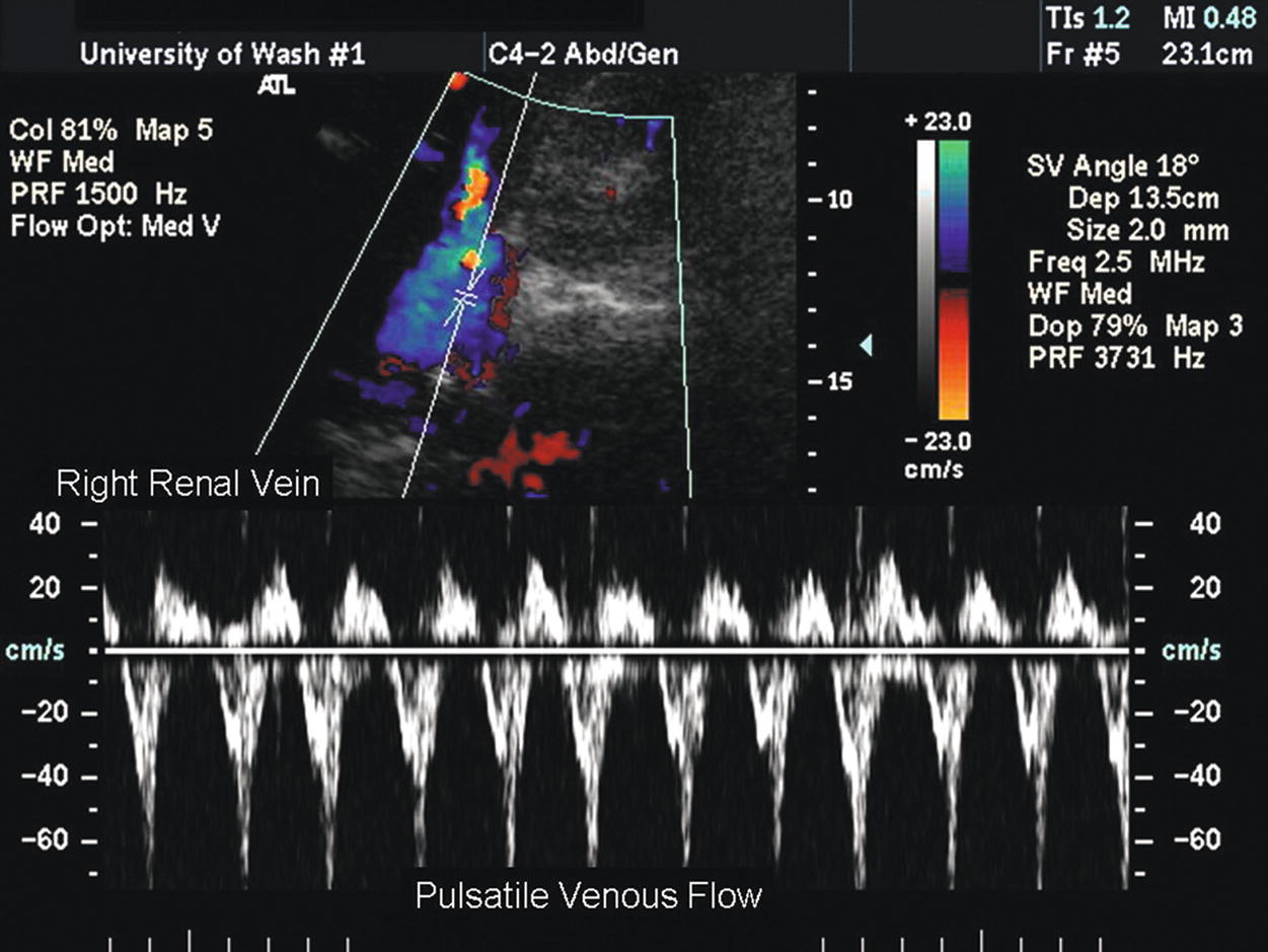 Renal Duplex Scanning | Thoracic Key