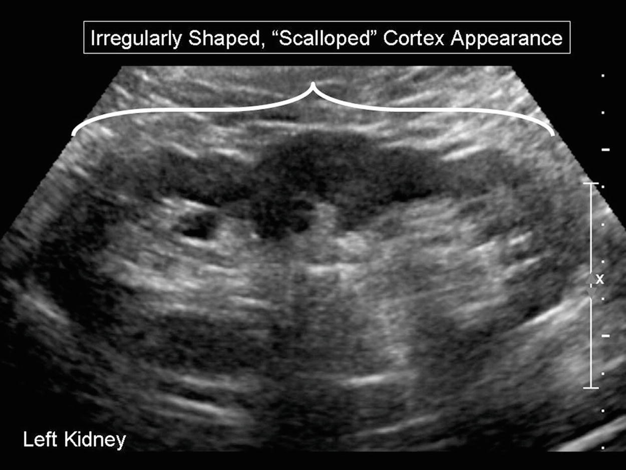 Renal Duplex Scanning | Thoracic Key