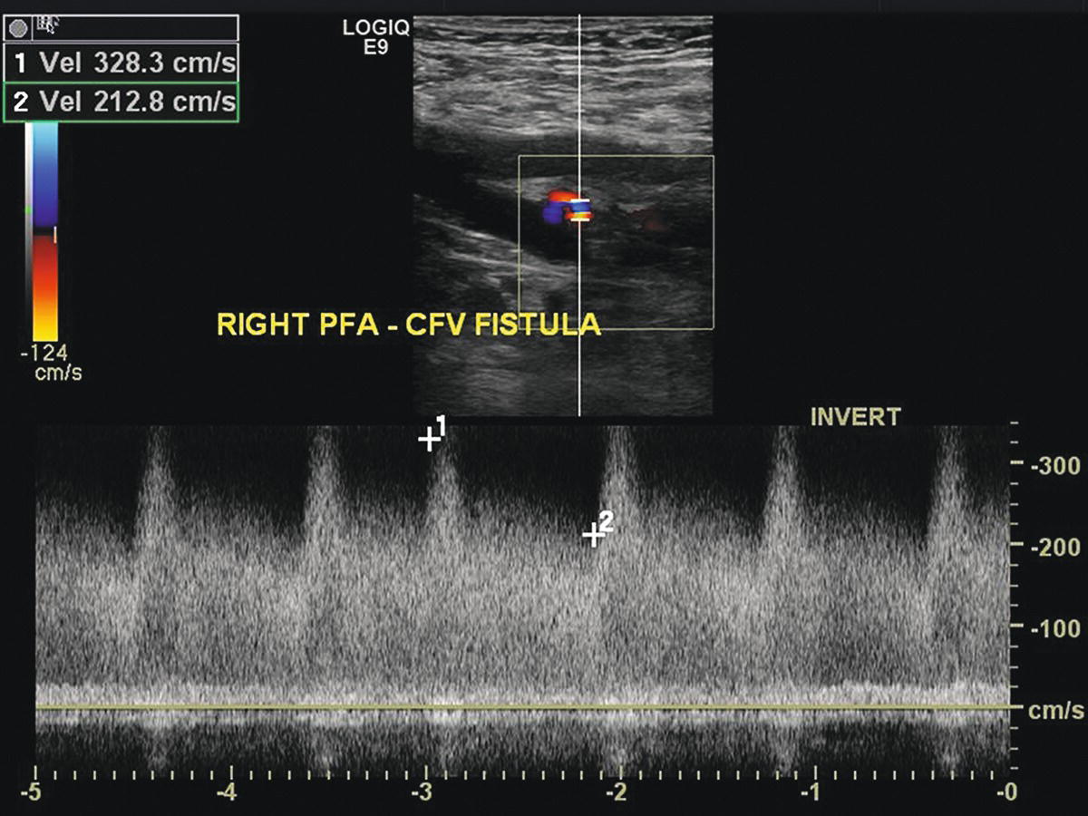 Evaluation and Treatment of Femoral Pseudoaneurysms | Thoracic Key